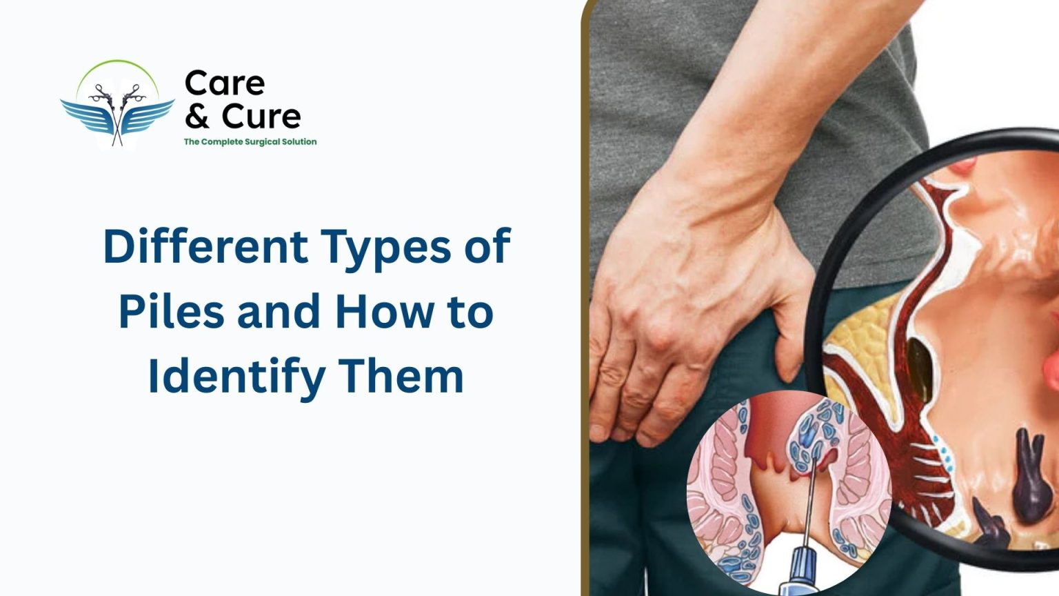 Different Types Of Piles And How To Identify Them - Dr. Rakesh Dhupia